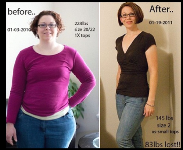 Why Weight Loss Surgery is a good choice - A Sedentary Lifestyle